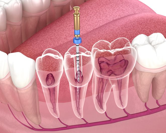 ¿Puedes necesitar una segunda endodoncia? | Clínica dental IMOI