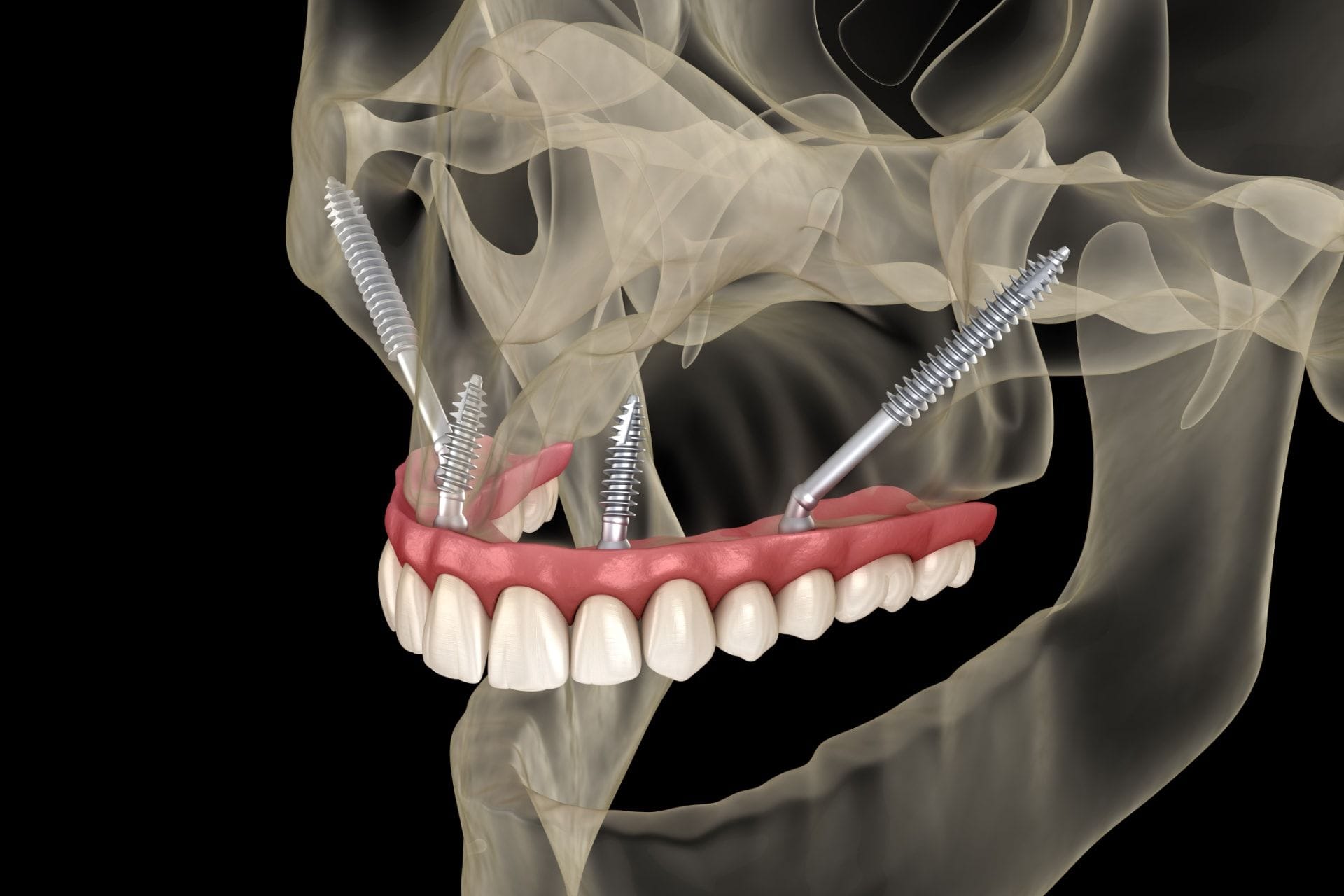 Implantes Zigomáticos en Eixample, Barcelona – Implantes Zigomáticos en ...